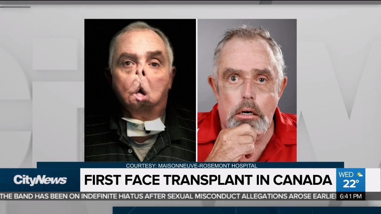 First face transplant in Canada