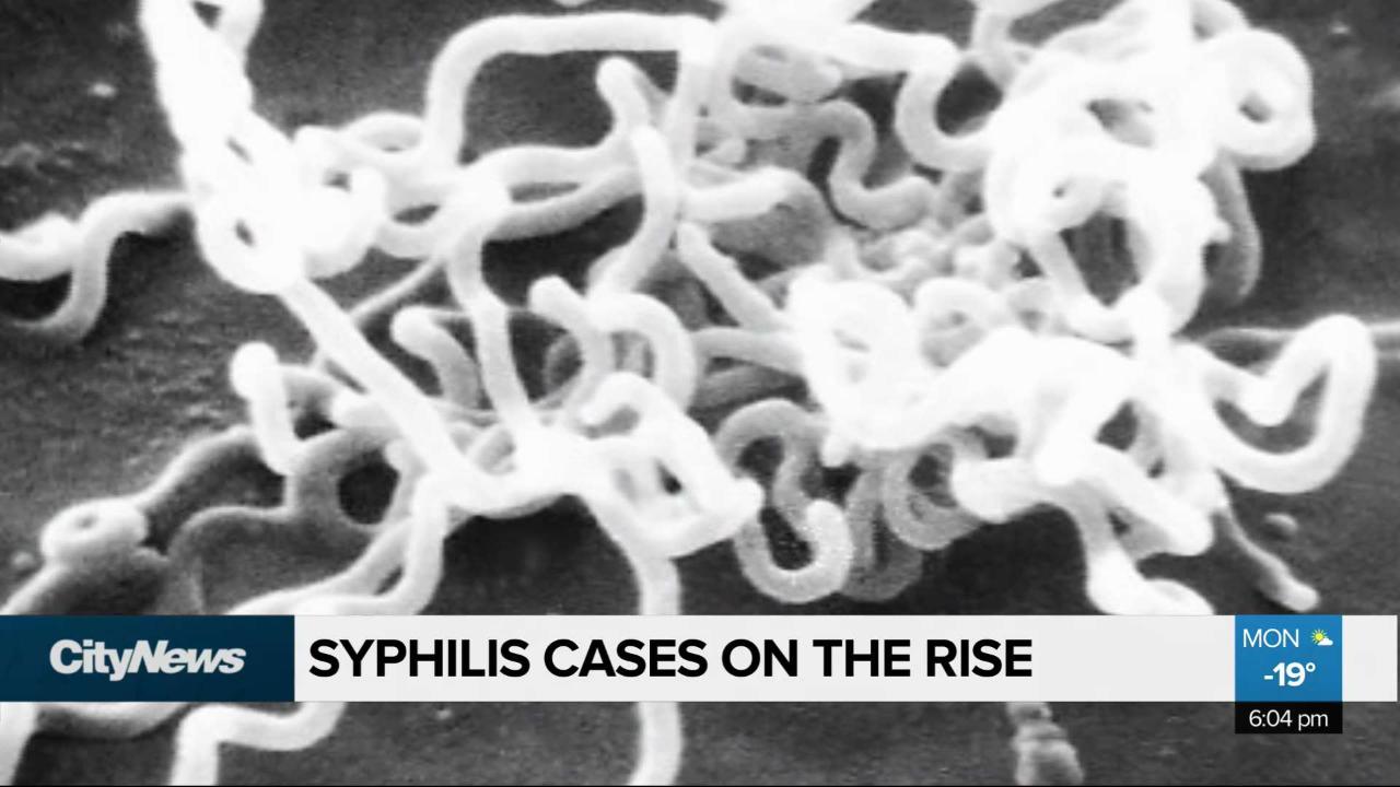 Syphilis cases increasing in Manitoba