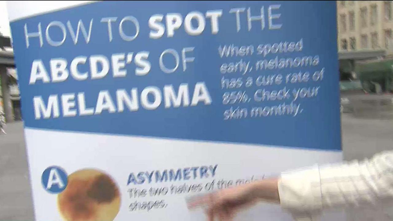 How to spot melanoma